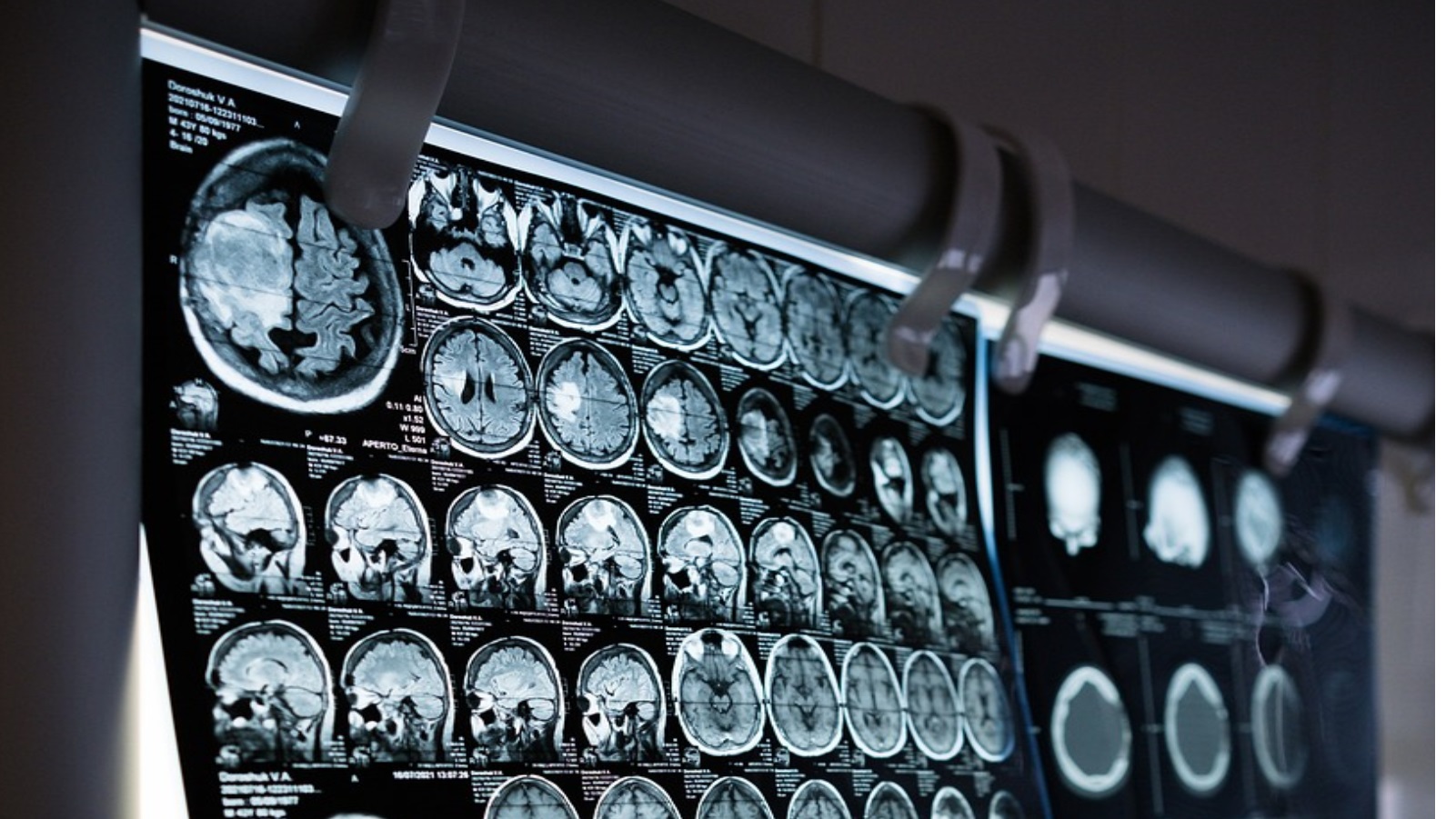 New super sponge could transform brain cancer treatment - News ...