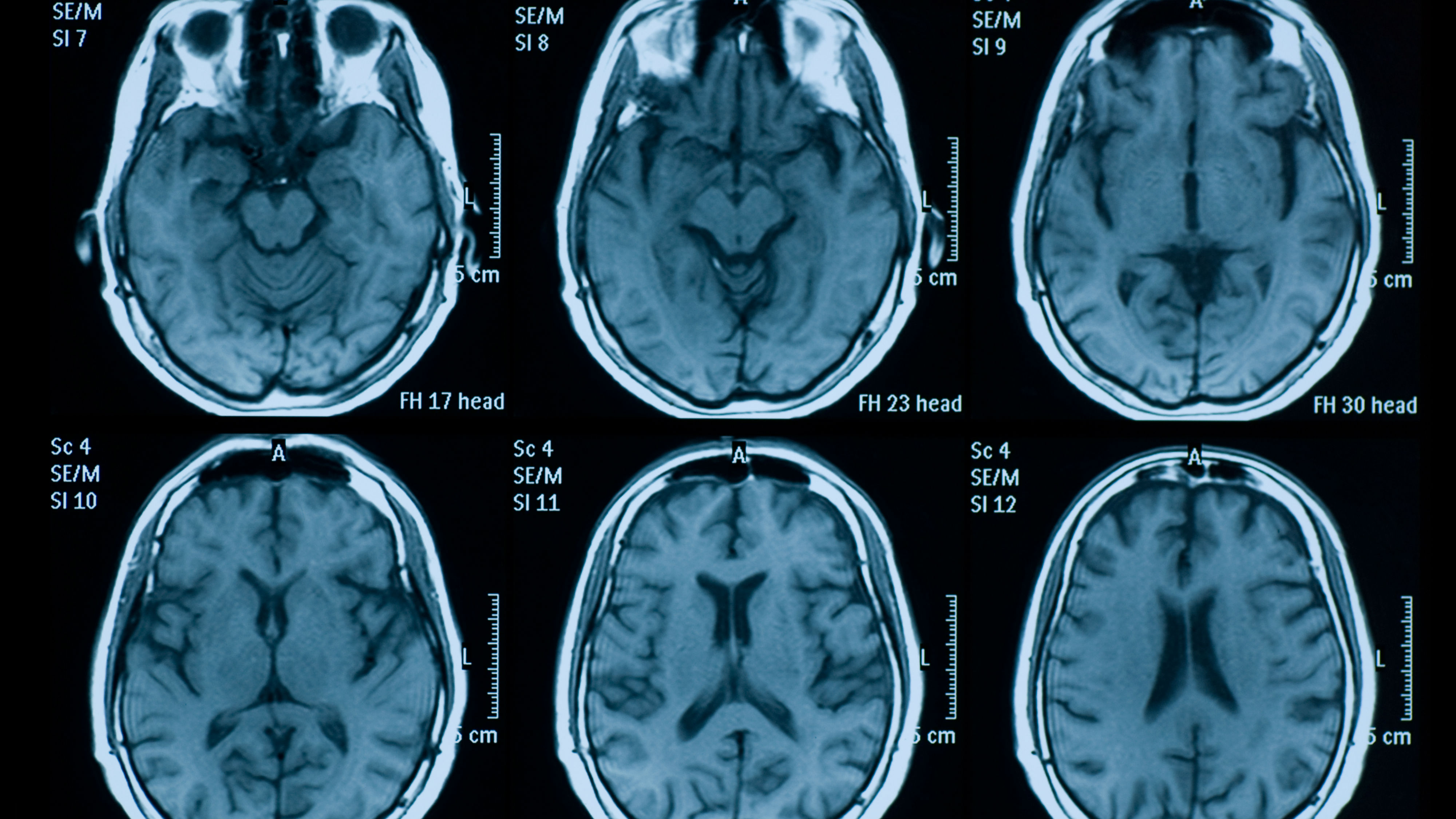 Huntington s Disease Starts In Childhood News Cardiff University
